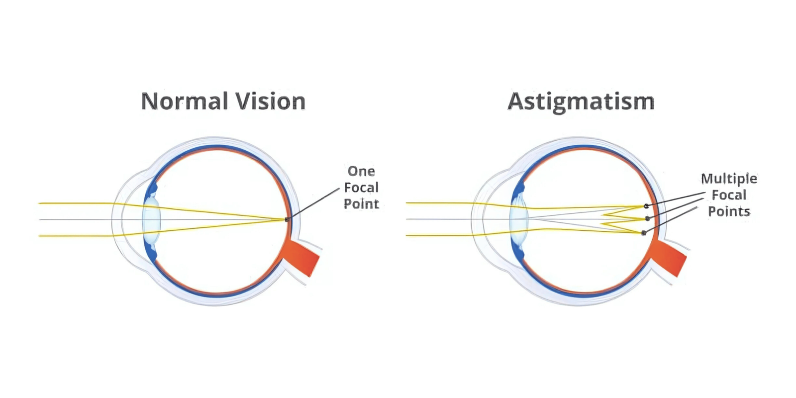 Understanding Astigmatism in Pakistan at Al-Aziz Optical